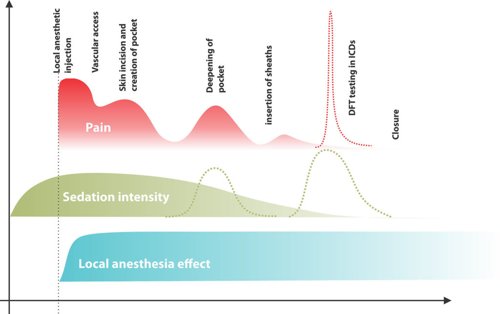 Sedation for Pacemaker Implantation – How to Pace