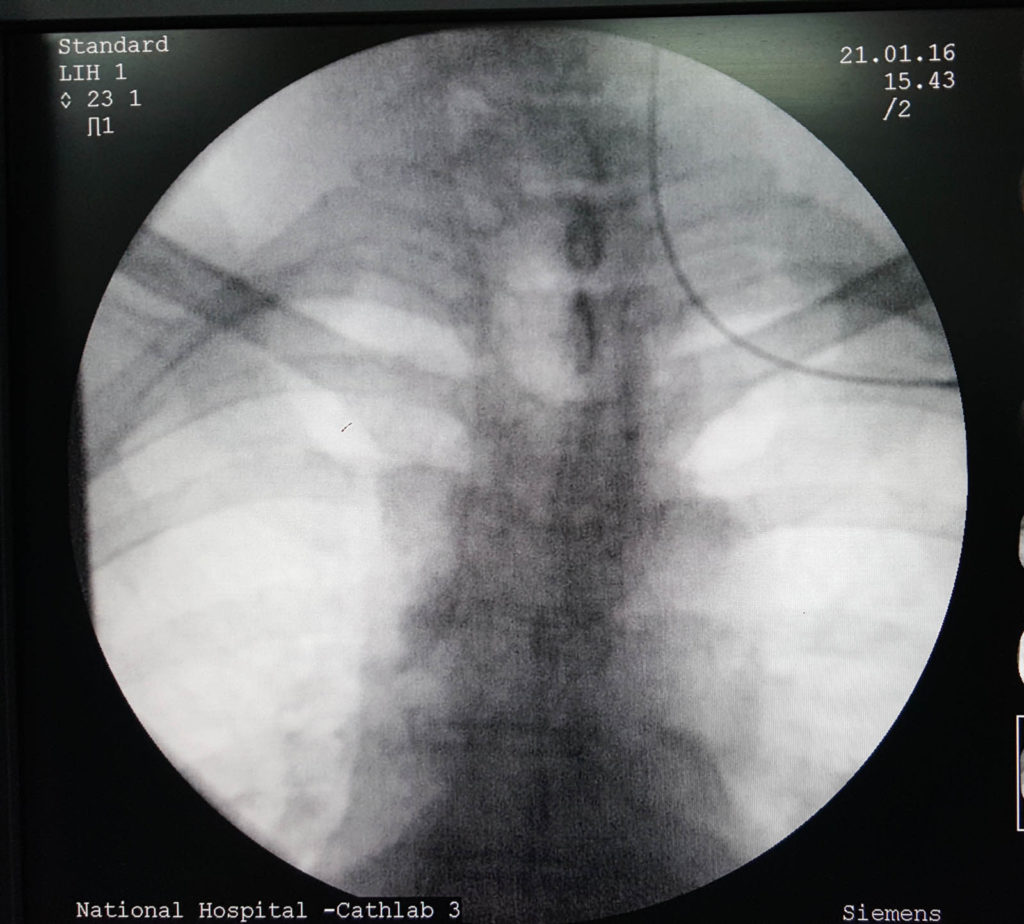 wire in neck – How to Pace