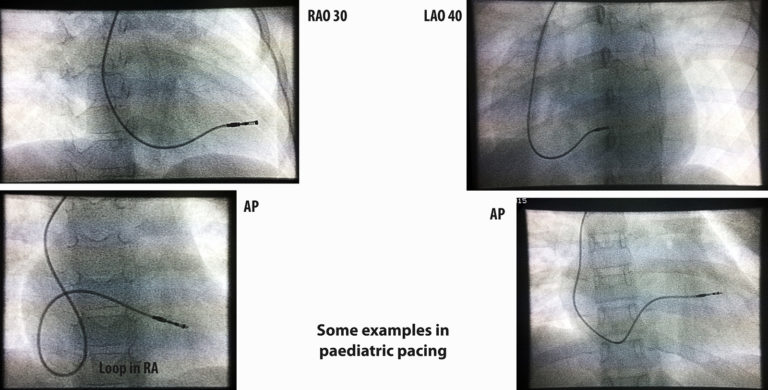Septal Implantation of Right Ventricular Lead – How to Pace
