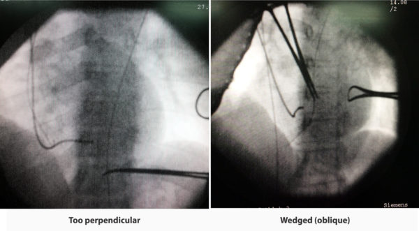 Septal Implantation of Right Ventricular Lead – How to Pace
