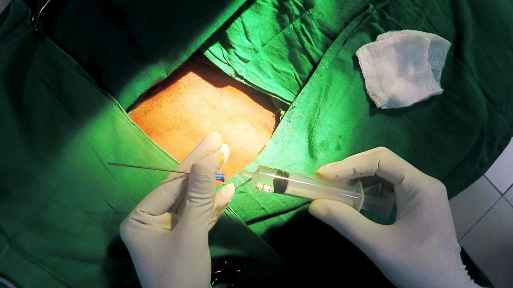 Subclavian Puncture – How to Pace