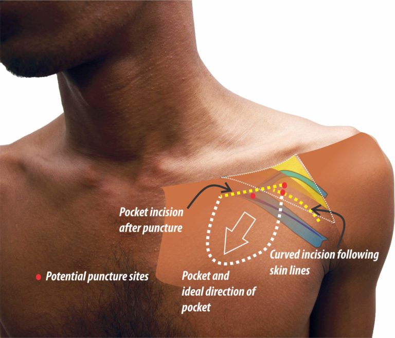 Anatomical Considerations for Creating the Pacemaker Pocket – How to Pace