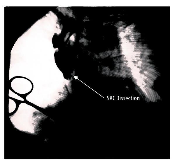 Septal Implantation of Right Ventricular Lead – How to Pace