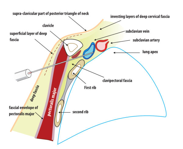 Anatomical Considerations for Creating the Pacemaker Pocket – How to Pace