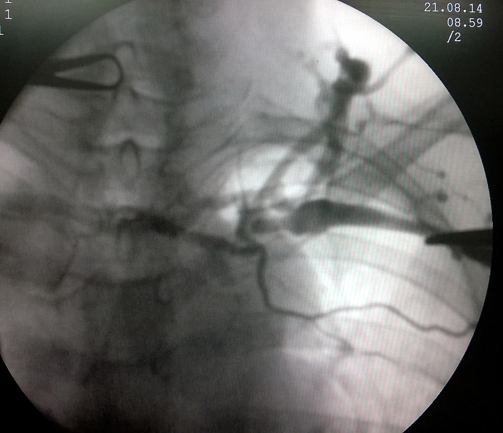 Role of Venography – How to Pace