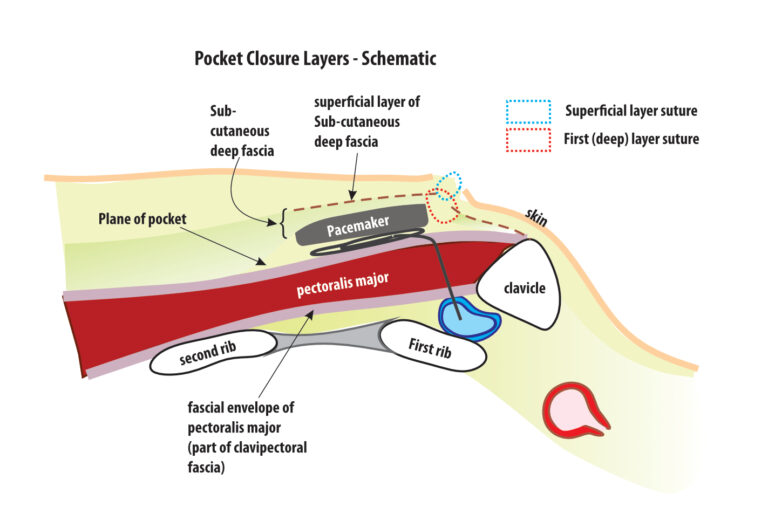 Closure of Pocket – How to Pace