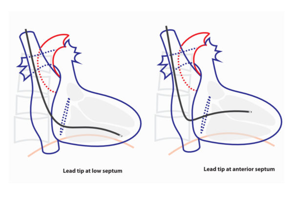 Septal Implantation of Right Ventricular Lead – How to Pace